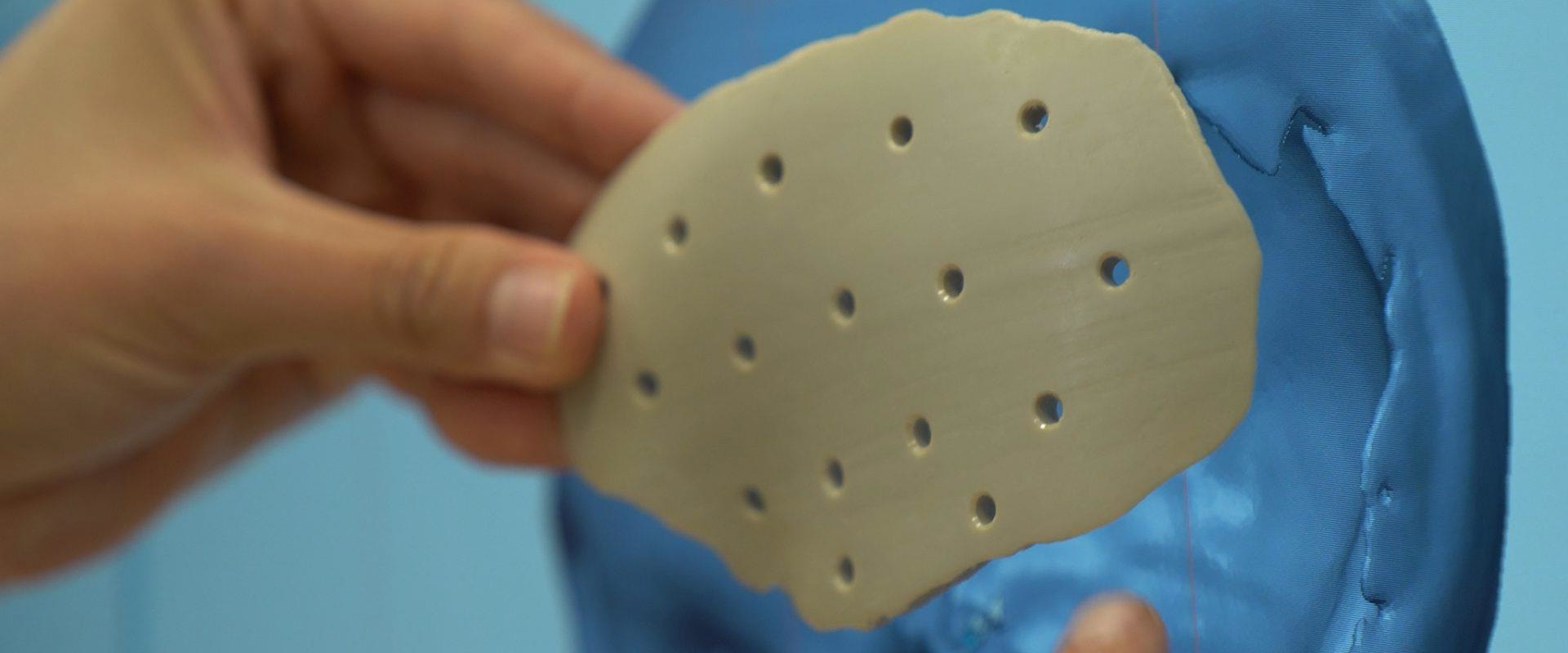 How is 3d printing used to create personalized prosthetics and implants ...