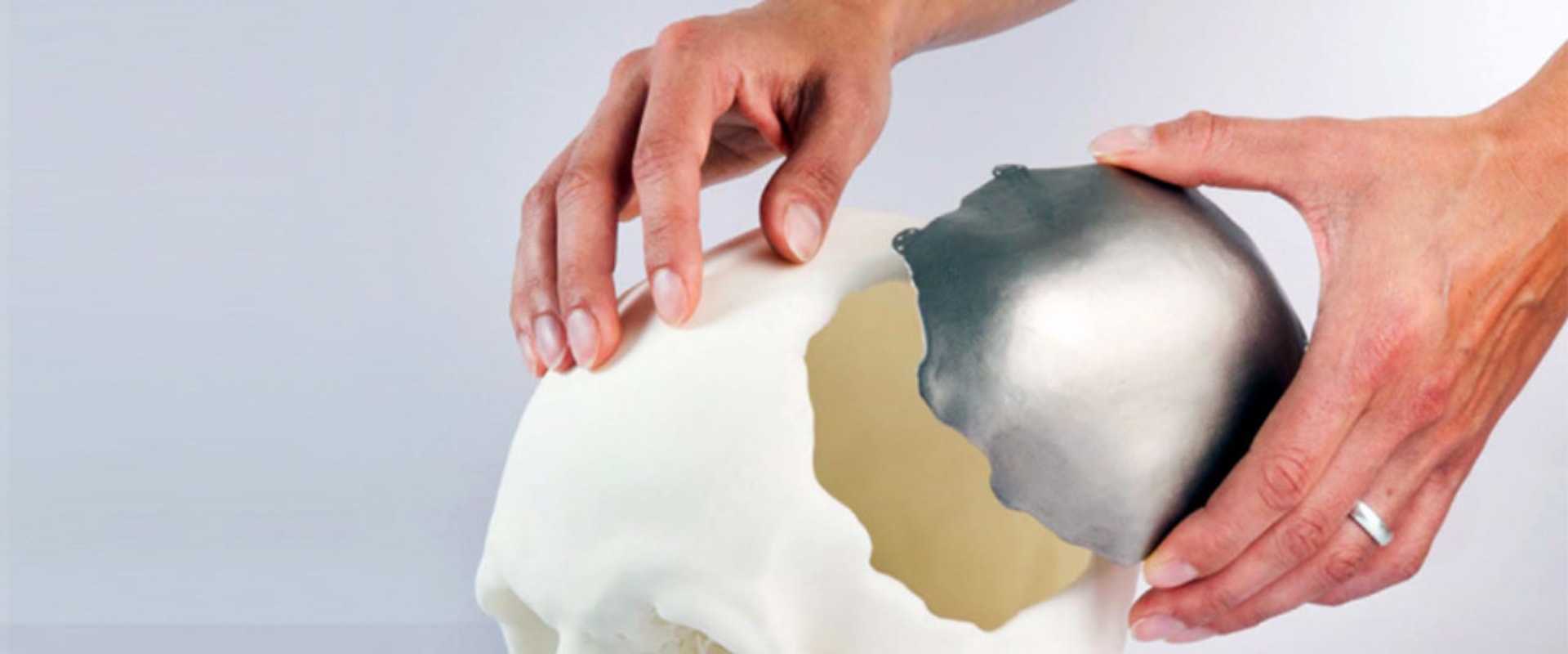 How is 3d printing used to create custom implants and prosthetics?